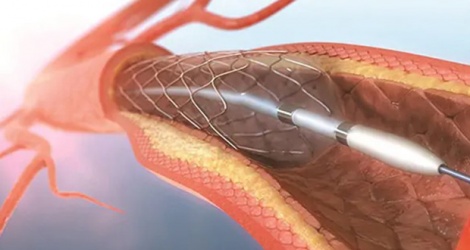 Ưu điểm và những lưu ý khi đặt stent động mạch vành