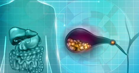 Sỏi mật 25,7mm dùng thực phẩm bảo vệ sức khỏe Kim Đởm Khang được không