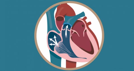 Chuyên gia giải đáp về bệnh hở van tim: Có mấy mức độ hở van tim?