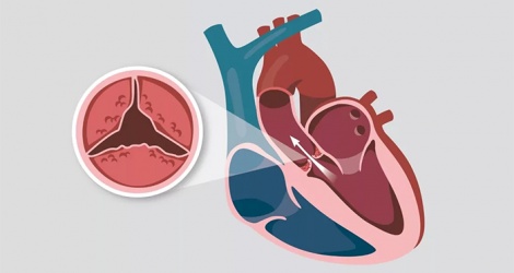 Hẹp van tim là gì và có những nguyên nhân nào gây hẹp van tim?