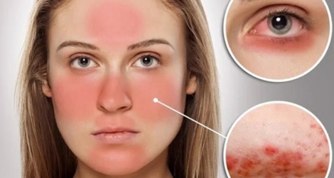 Bệnh lupus ban đỏ có chữa khỏi được không?